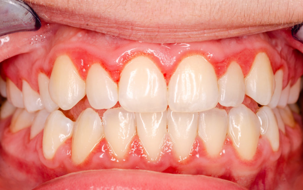 What Are the Consequences of Overgrown Gums?